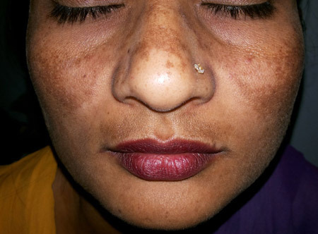 Melasma - Comparison of all treatment options