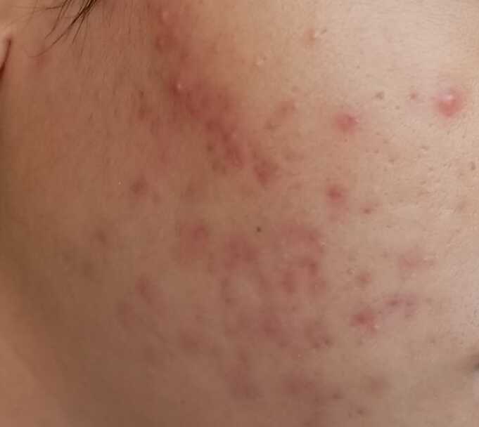 Moderate acne